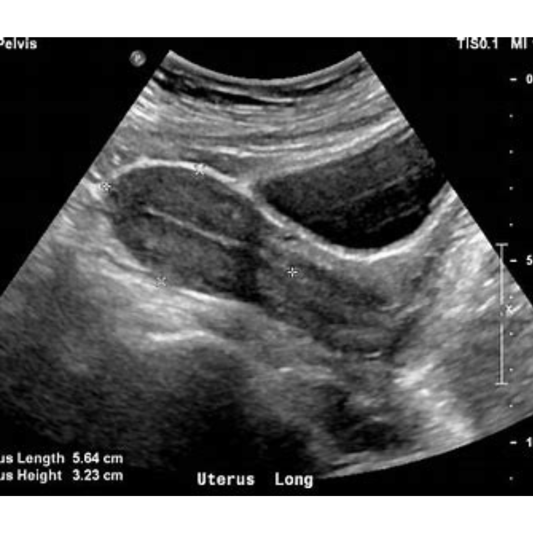 Pelvic Ultrasound. – Ecoworldsye